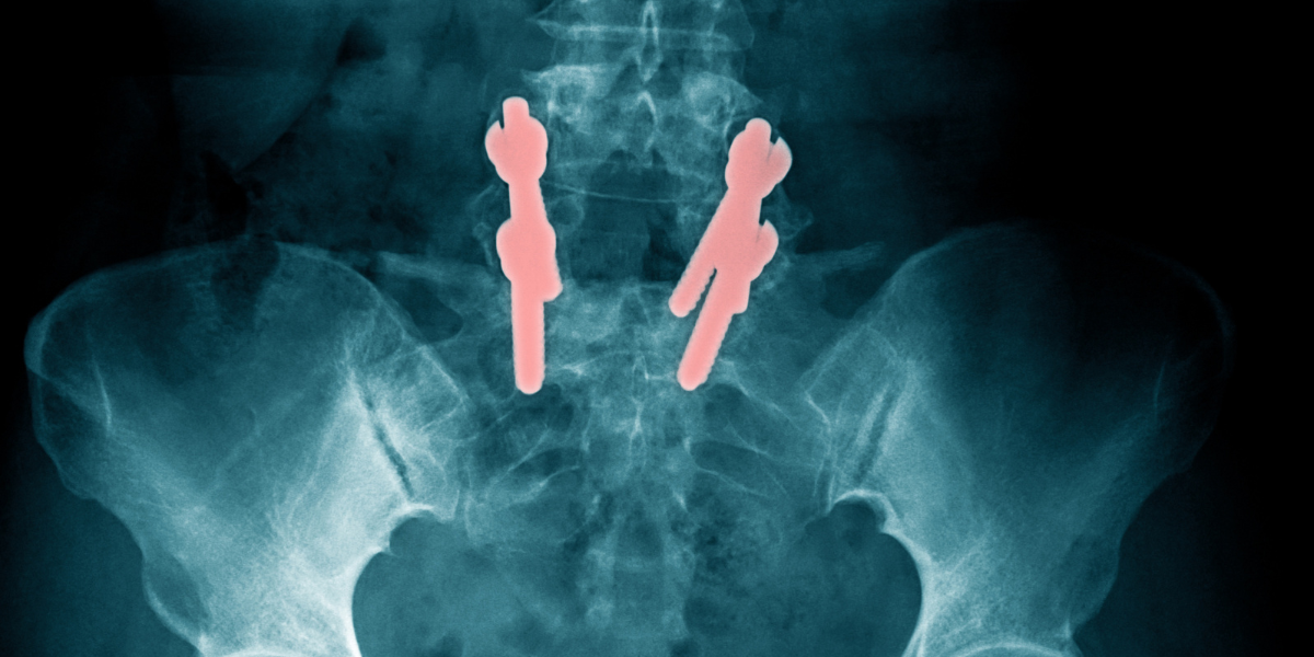 Spine Fixation